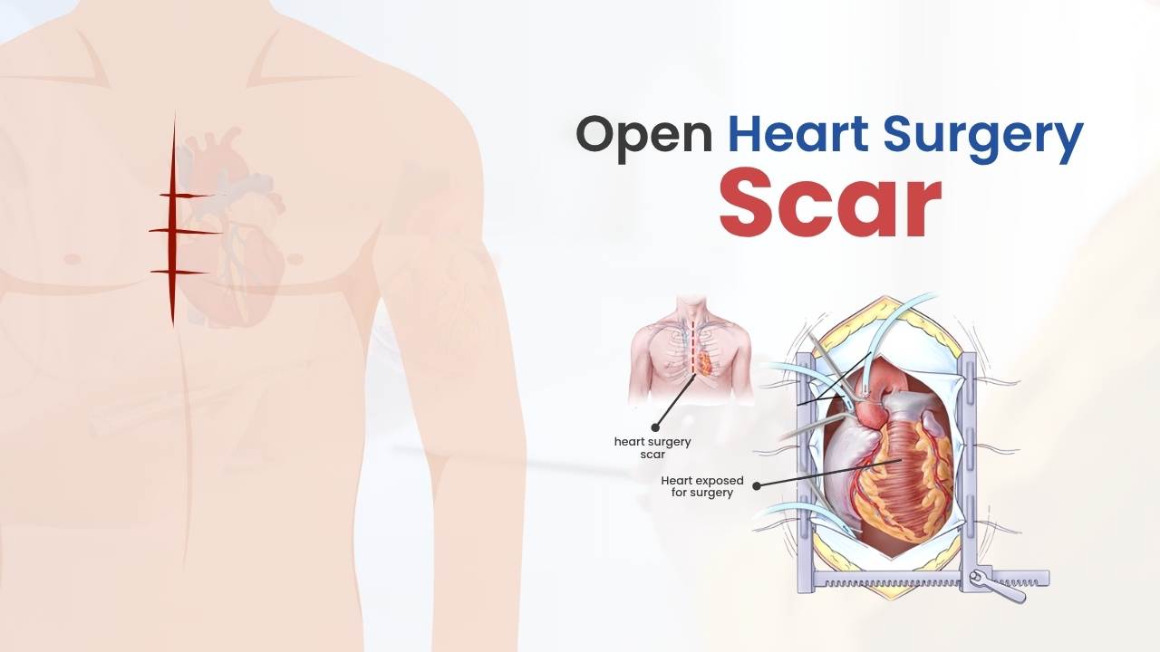 Open Heart Surgery Scar | How to care for your Scars