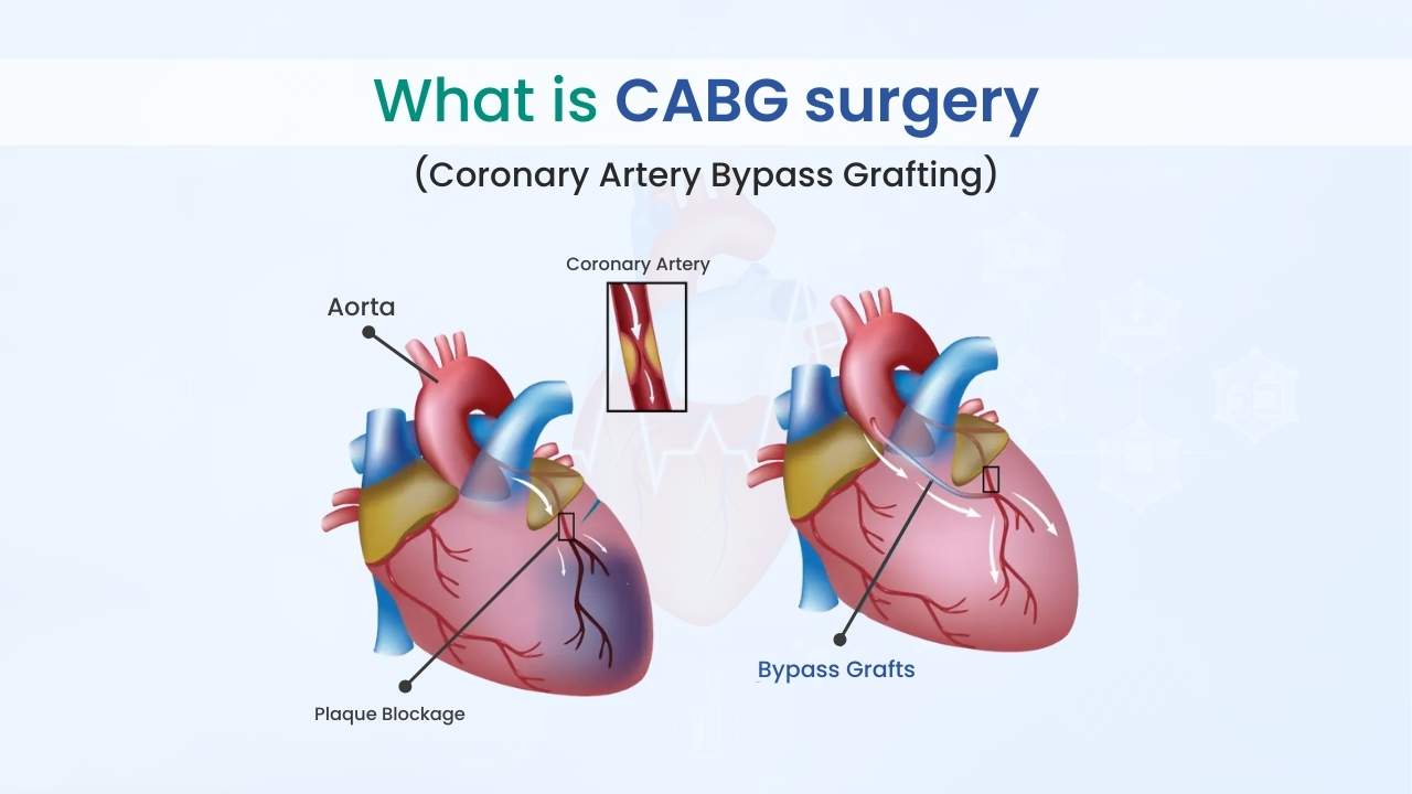 Know About Coronary Artery Bypass Grafting Cabg Best CABG (Coronary